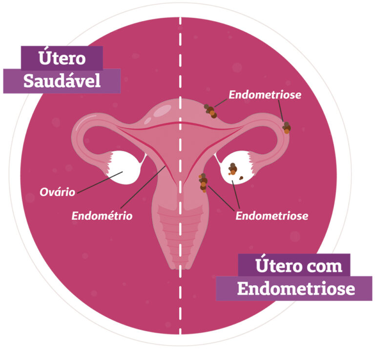 Entenda a Endometriose e Seus Impactos na Saúde